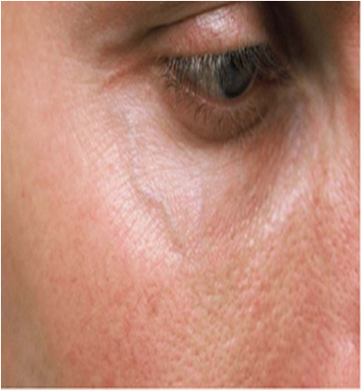 Ευρυαγγείες Προσώπου - Neotis - Neotis