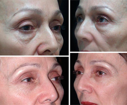 Accent - Neotis - Neotis