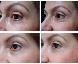 Accent - Neotis - Neotis